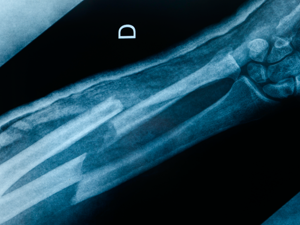 How Much Force Does It Take To Break A Bone? | Discovery